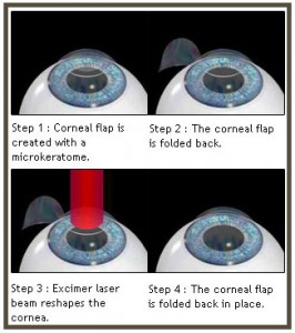 LASIK: Permanent Vision Correction as a Prep